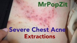 Large clogged pores emptied from chest area. Extraction techniques.Many ...