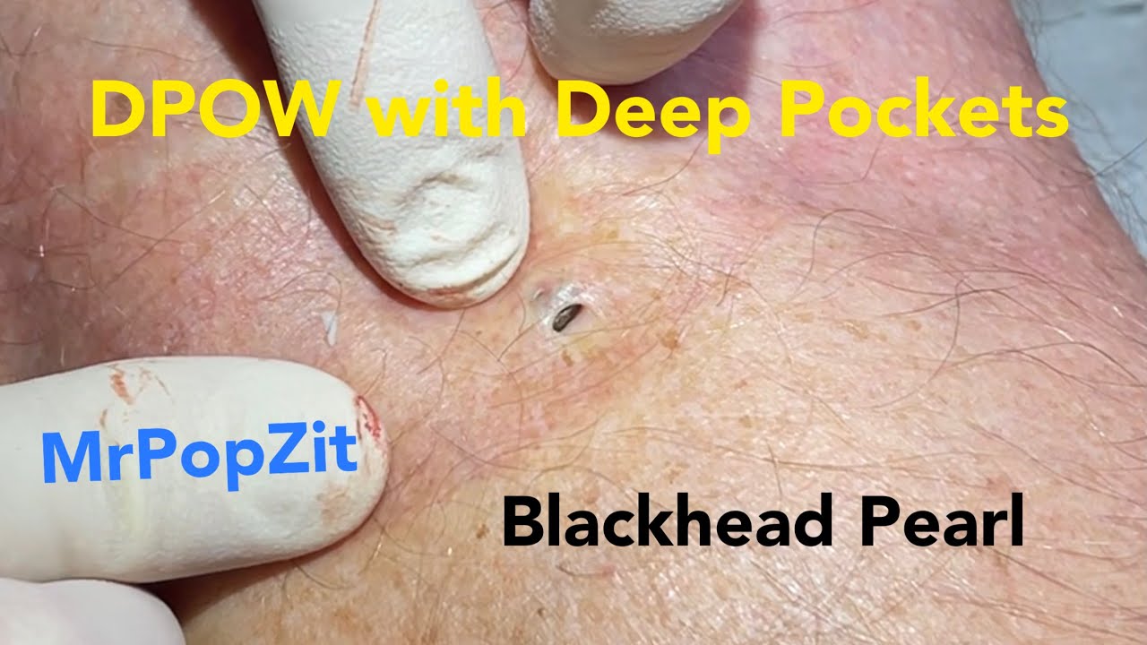 The Blackhead with deep pockets. DPOW blackhead pearl extraction on the ...