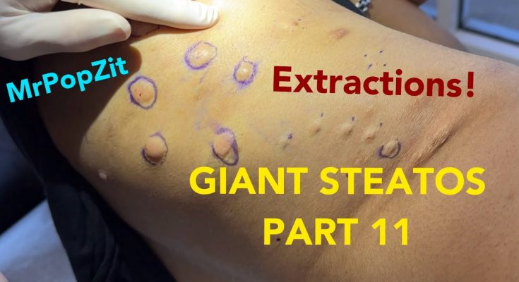 Extractions! Giant STEATOS, blackheads, vellus hairs, and ingrown hairs ...